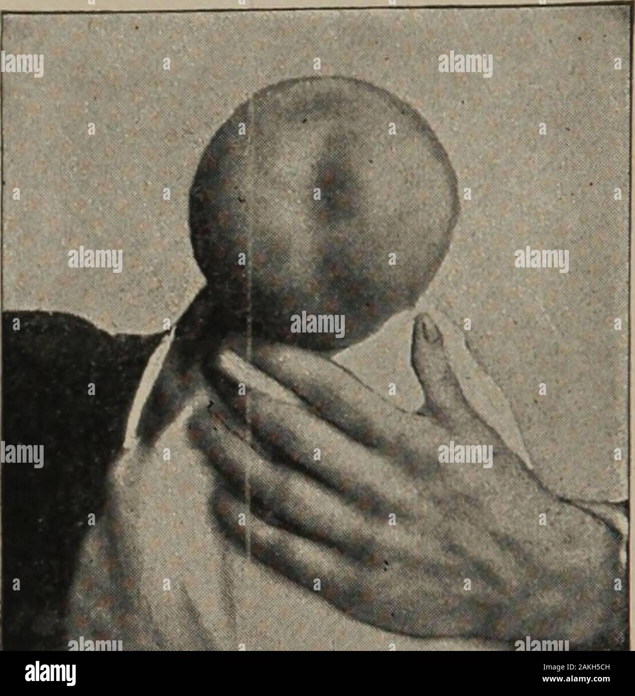 A nurse's handbook of obstetrics . Fig. 162.—Caput succedancum. Male ...