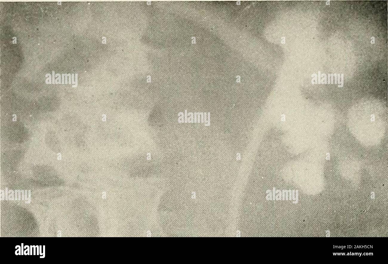 Pyelography (pyelo-ureterography) a study of the normal and pathologic ...