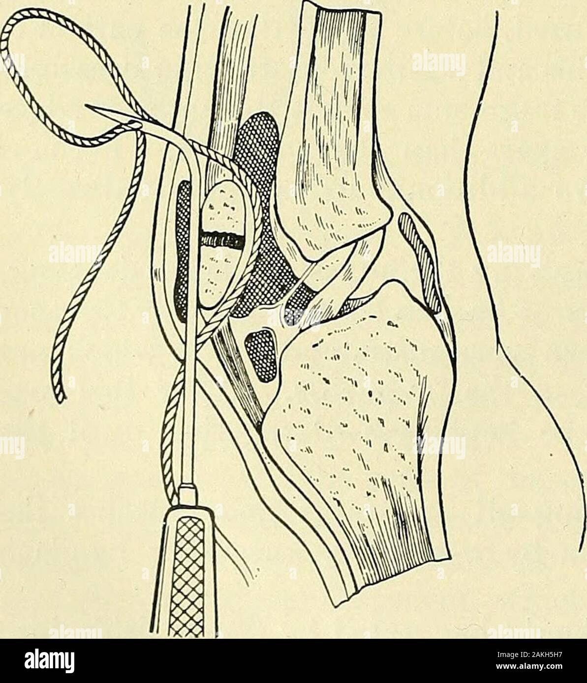 Silk suture hi-res stock photography and images - Alamy
