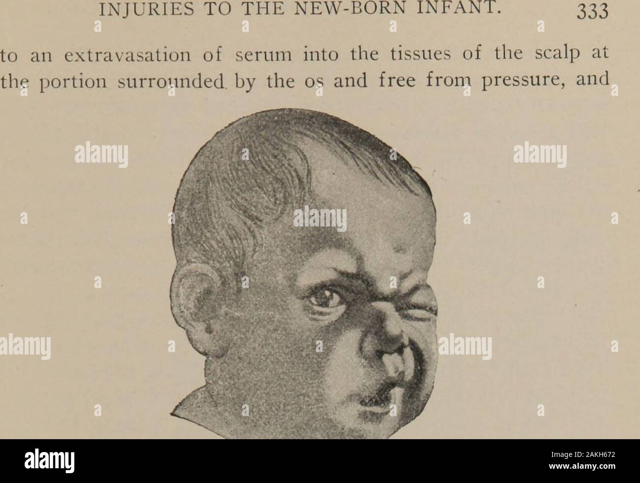 Caput succedaneum hi-res stock photography and images - Alamy