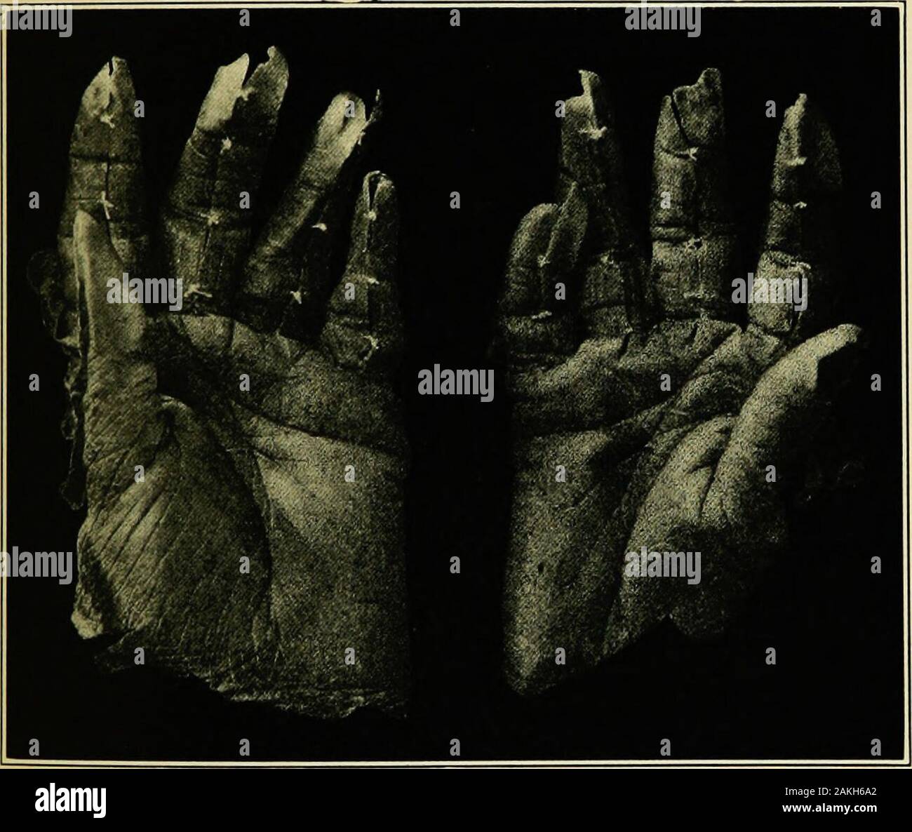 Desquamation of the skin hi-res stock photography and images - Alamy