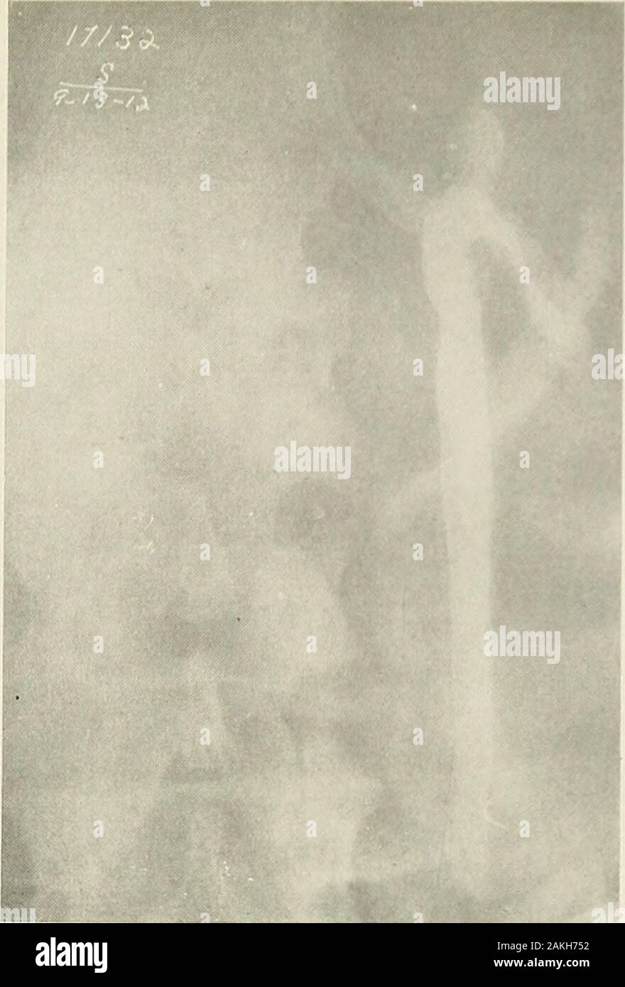 Pyelography (pyelo-ureterography) a study of the normal and pathologic ...