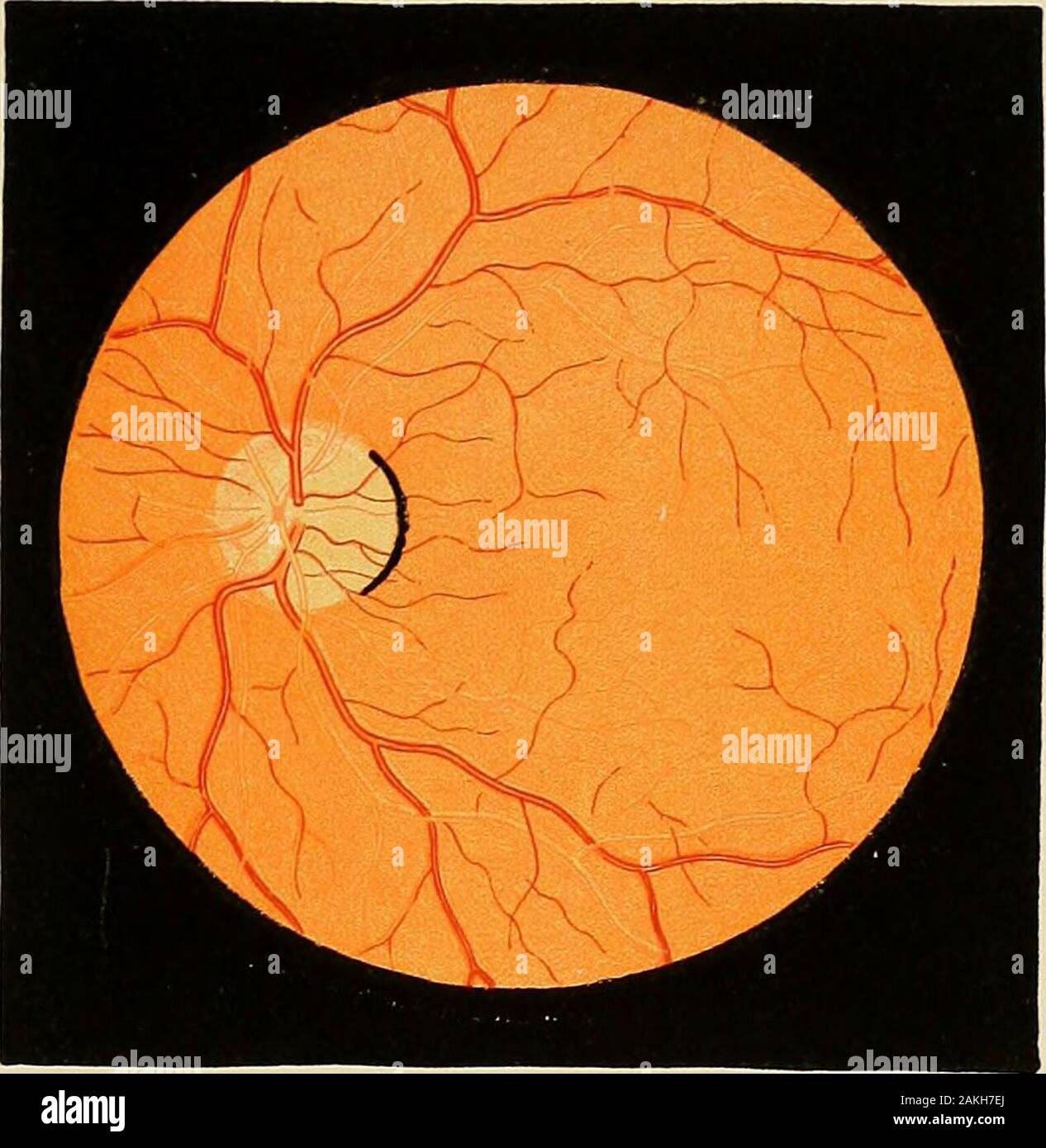 Scotoma hi-res stock photography and images - Alamy