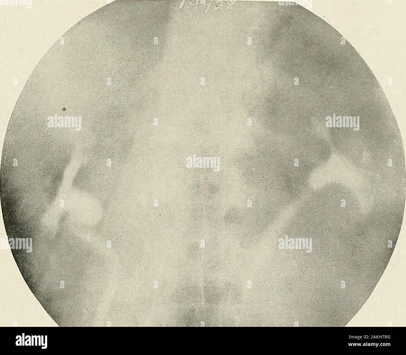 Renal calyces hi-res stock photography and images - Alamy