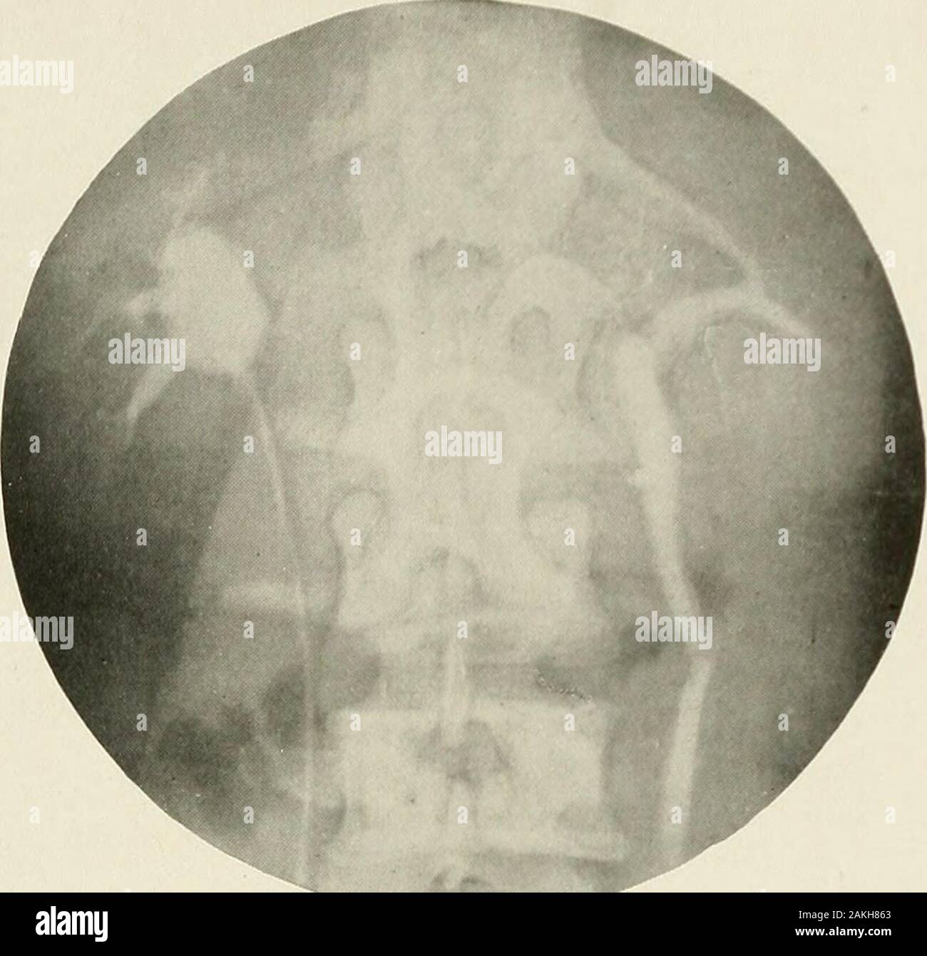 Pyelography (pyelo-ureterography) a study of the normal and pathologic ...