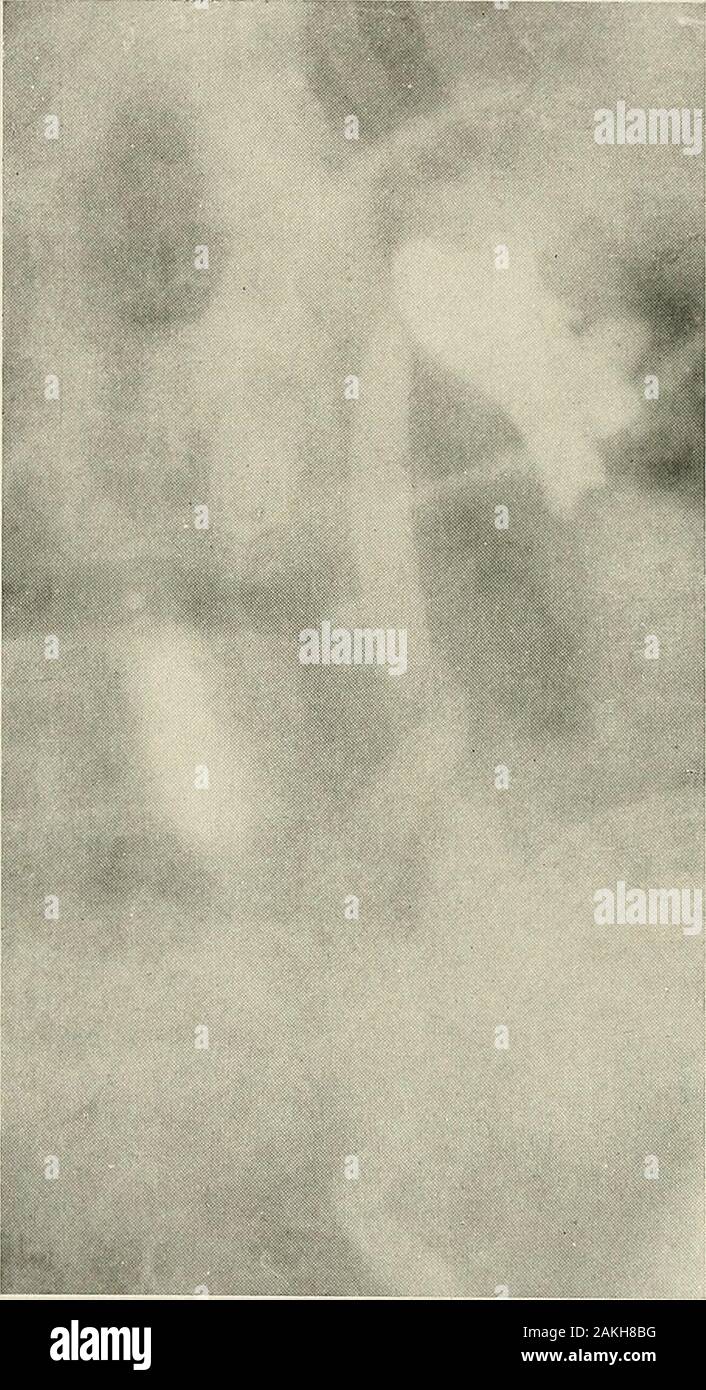 Pyelography (pyelo-ureterography) a study of the normal and pathologic ...