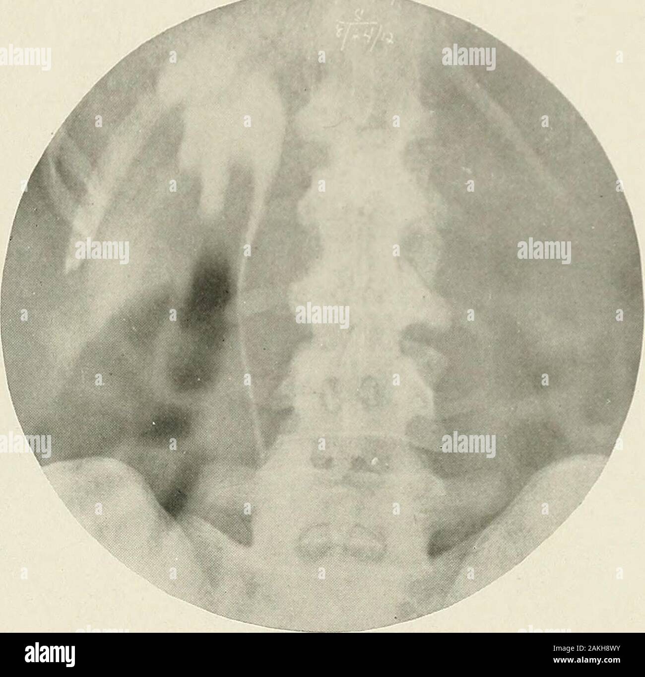 Renal Calyces Stock Photos & Renal Calyces Stock Images - Alamy