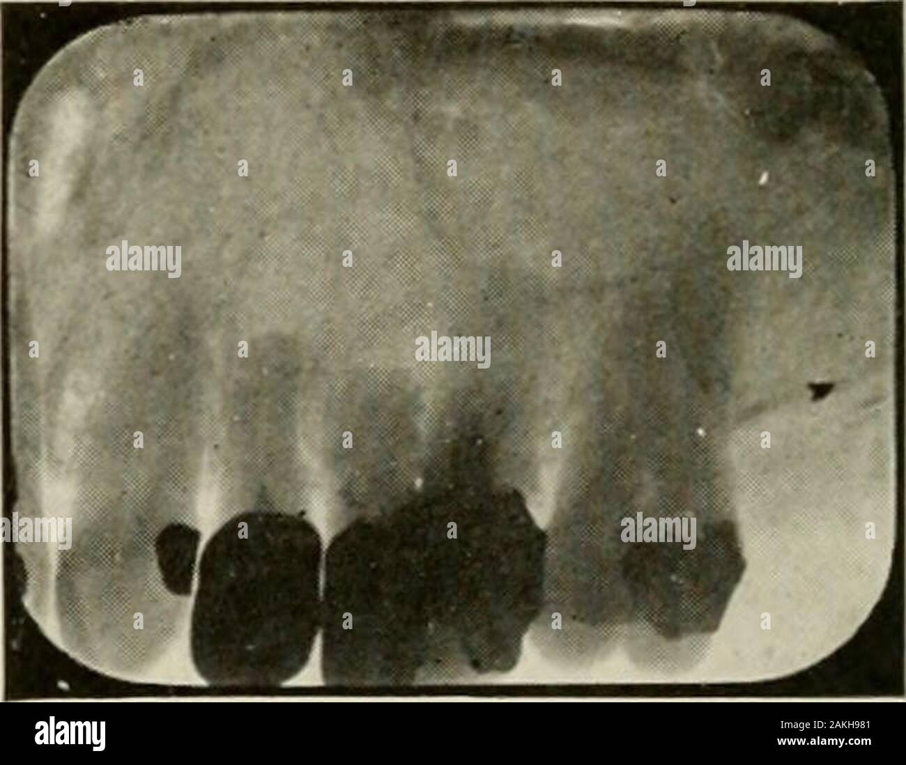 Apical foramen hi-res stock photography and images - Alamy