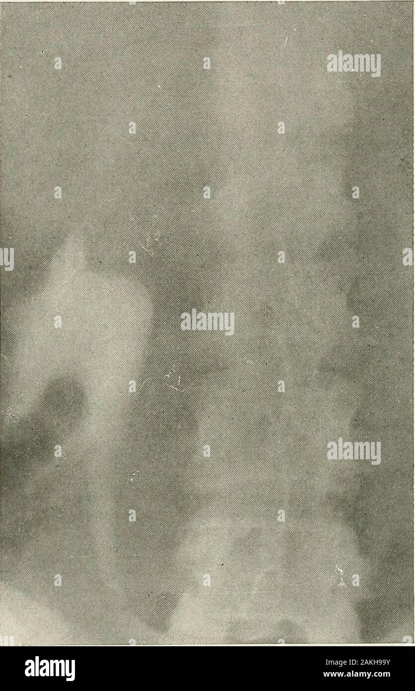 Pyelography (pyelo-ureterography) a study of the normal and pathologic ...