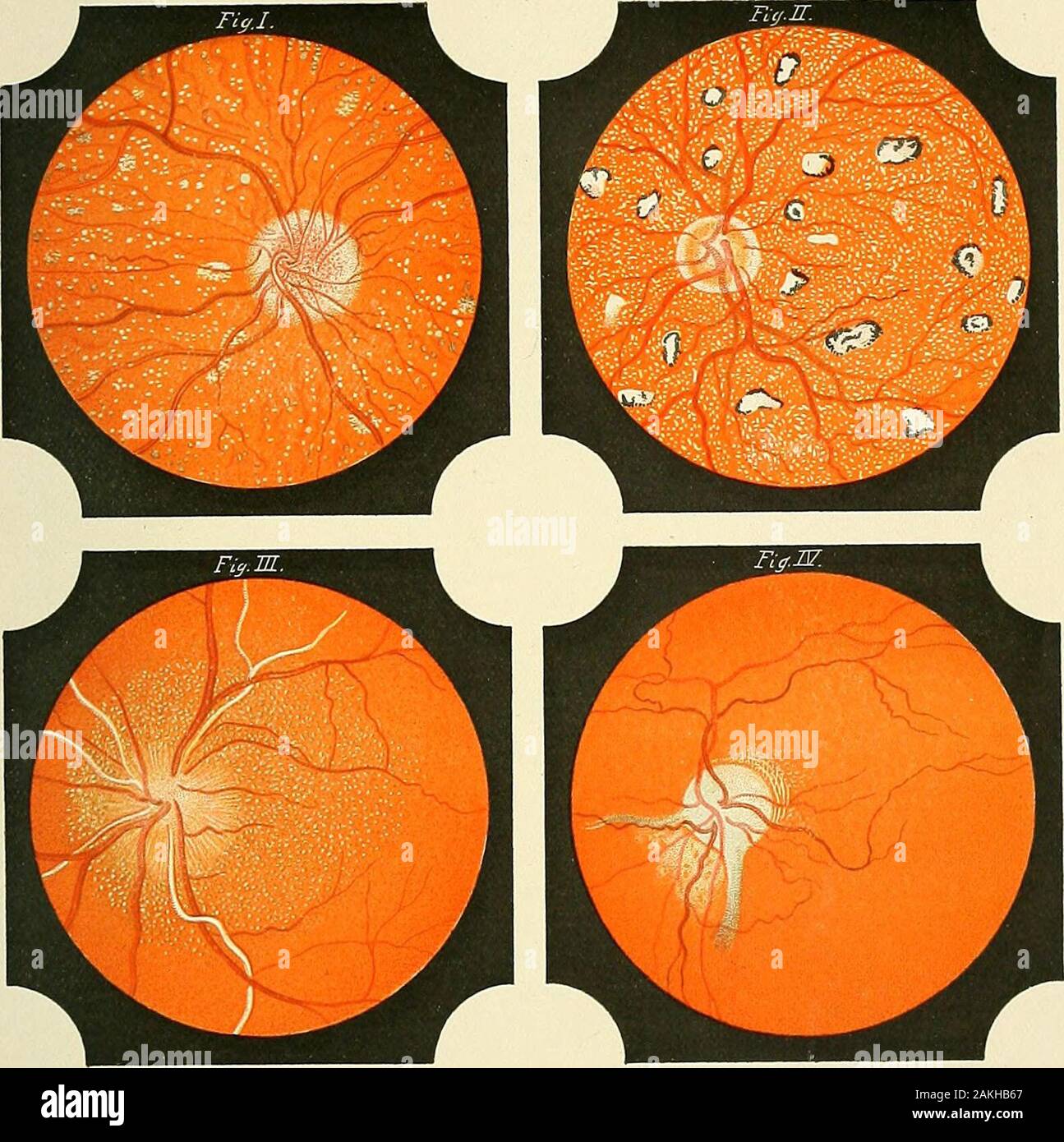 Tortuous Veins Eyes Clipart