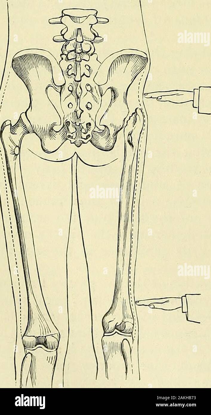 Impacted fracture hi-res stock photography and images - Alamy