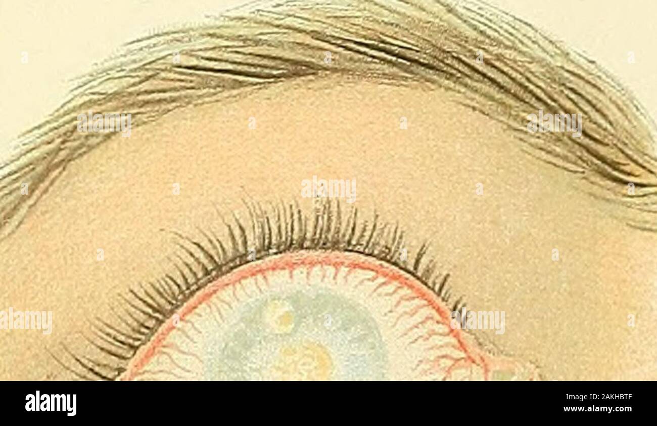 Syphilis chancre hi-res stock photography and images - Alamy