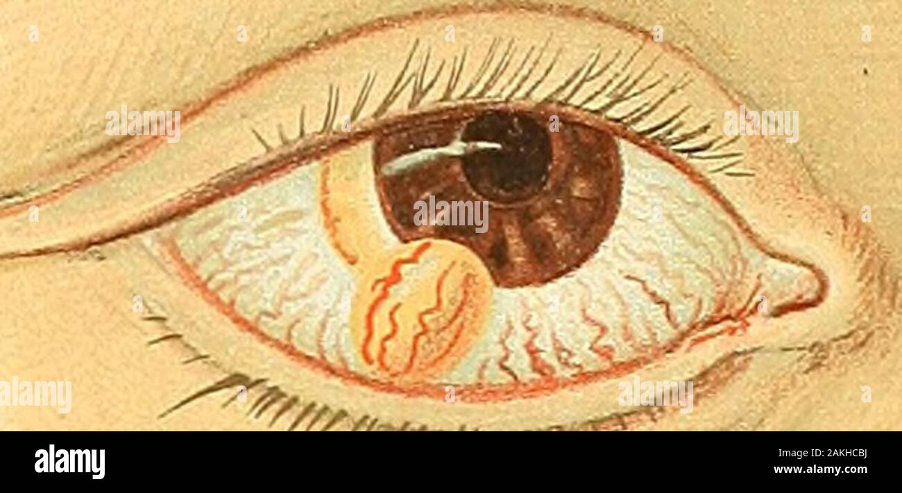 An American text-book of genito-urinary diseases, syphilis and diseases ...