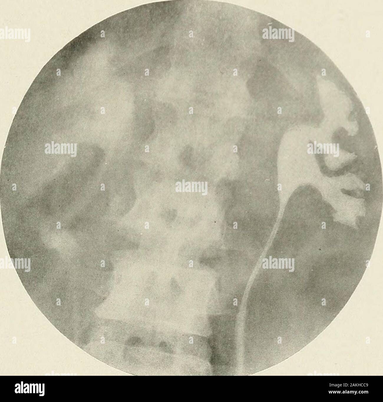 Pyelography (pyelo-ureterography) a study of the normal and pathologic ...