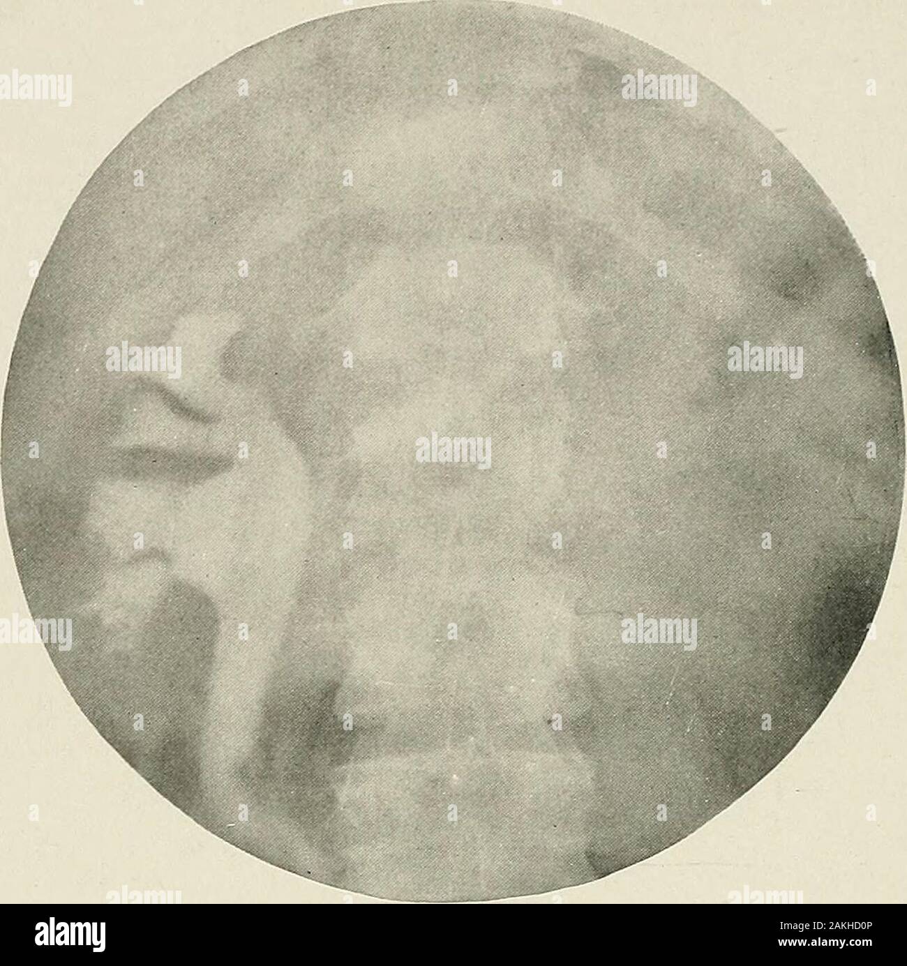 Pyelography (pyelo-ureterography) a study of the normal and pathologic ...