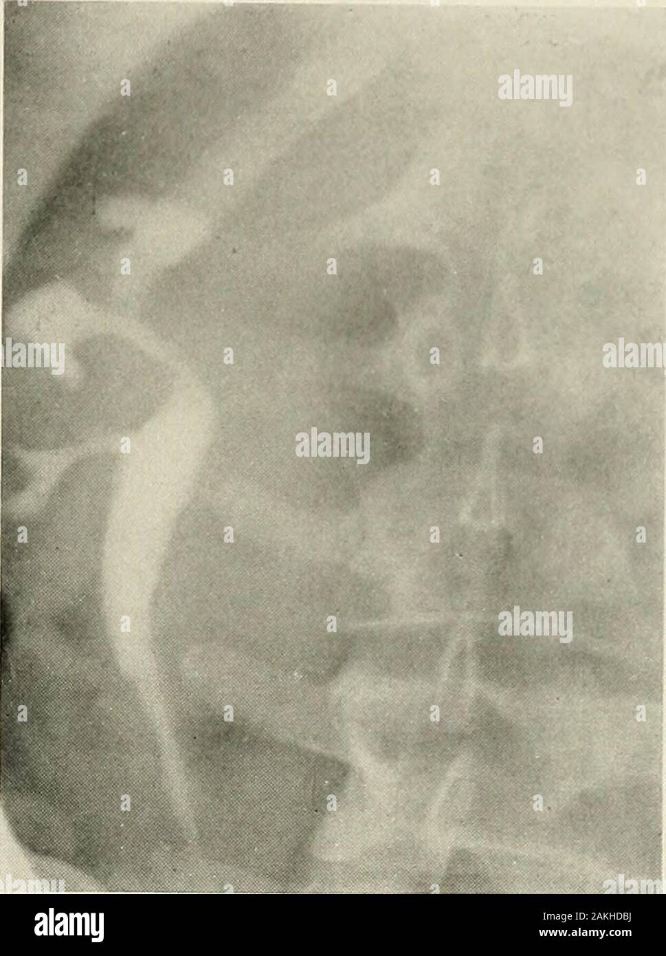 Renal Calyces Stock Photos & Renal Calyces Stock Images - Alamy