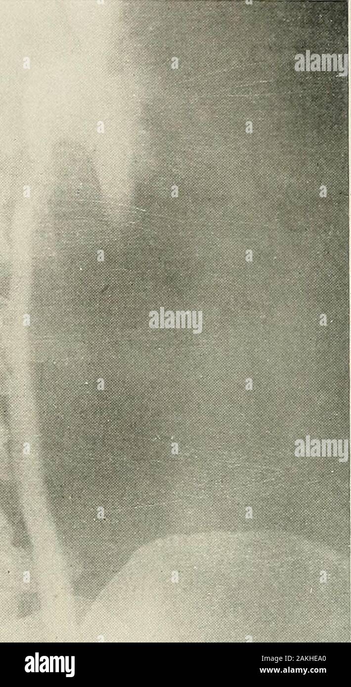 Pyelography (pyelo-ureterography) a study of the normal and pathologic ...