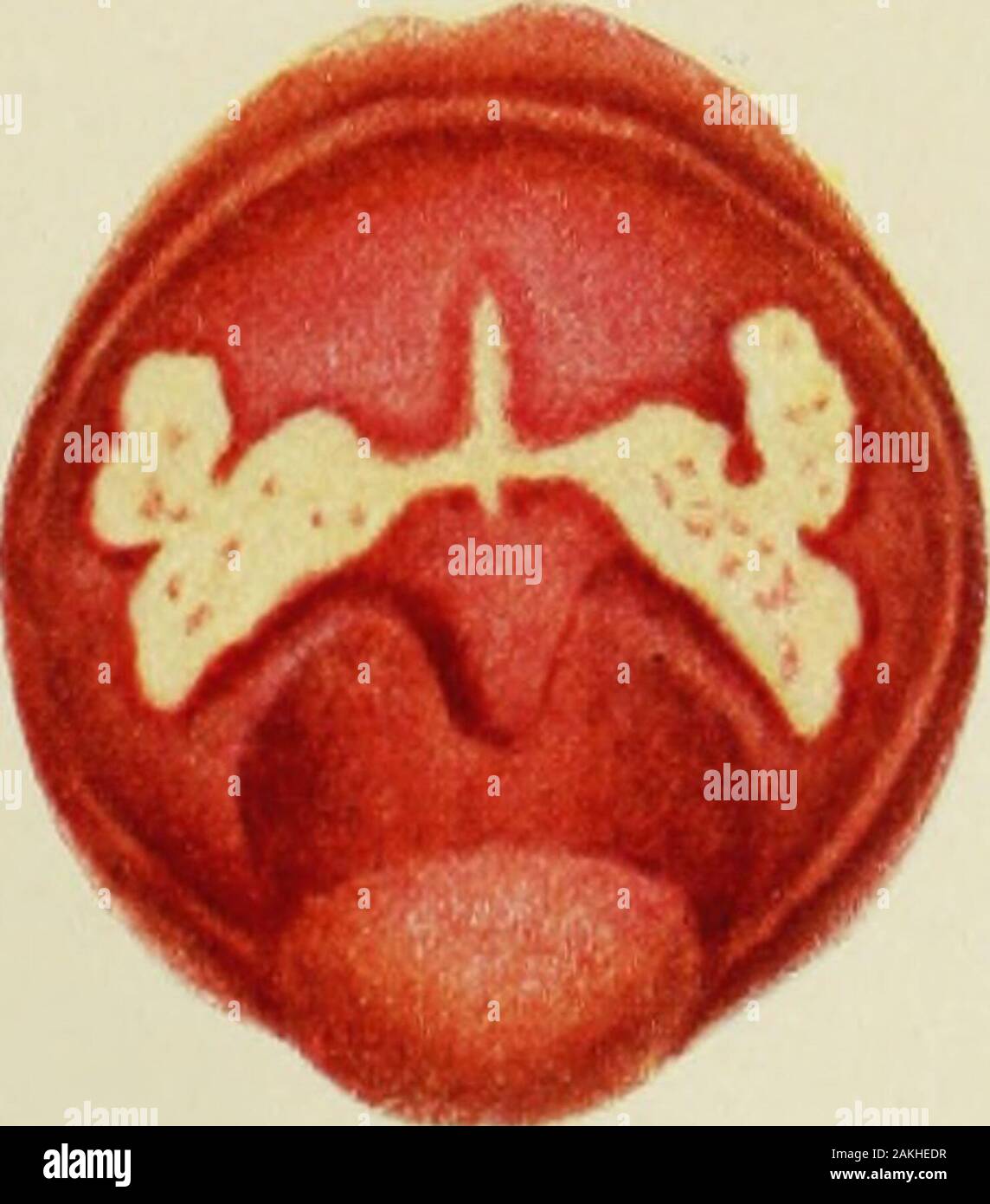 Swollen Tonsils Stock Photos & Swollen Tonsils Stock Images - Alamy