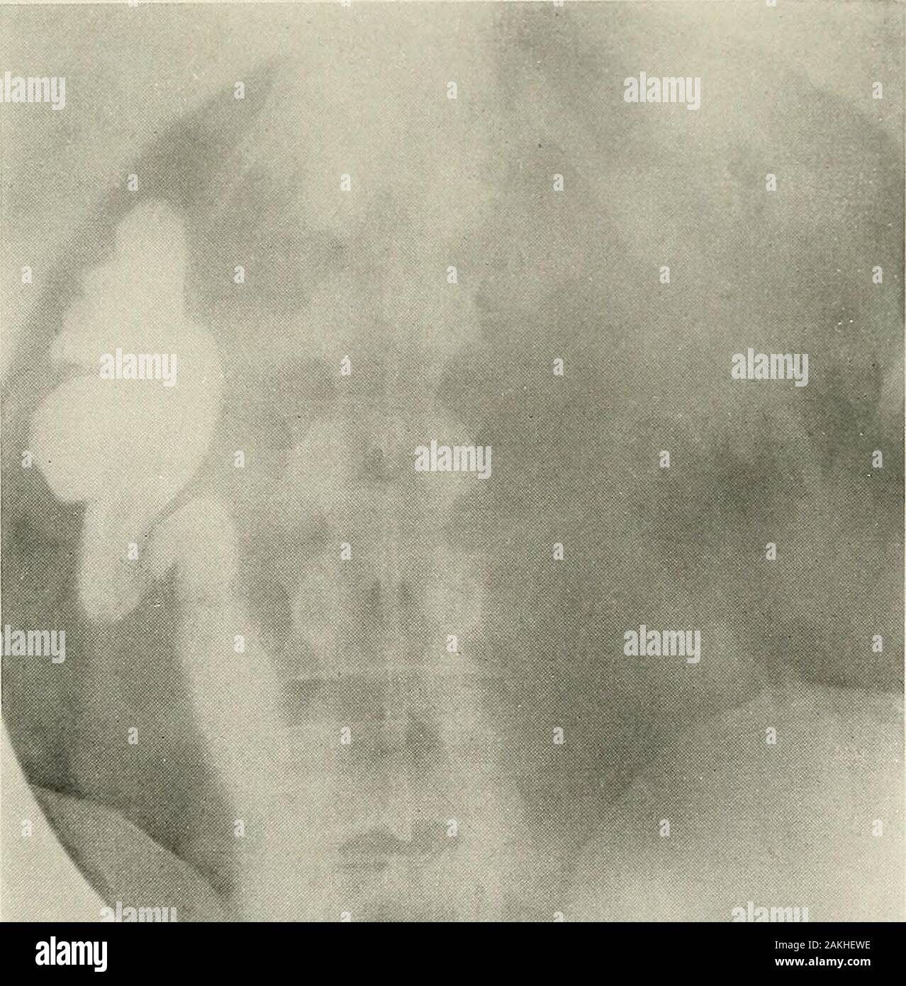 Pyelography (pyelo-ureterography) a study of the normal and pathologic ...