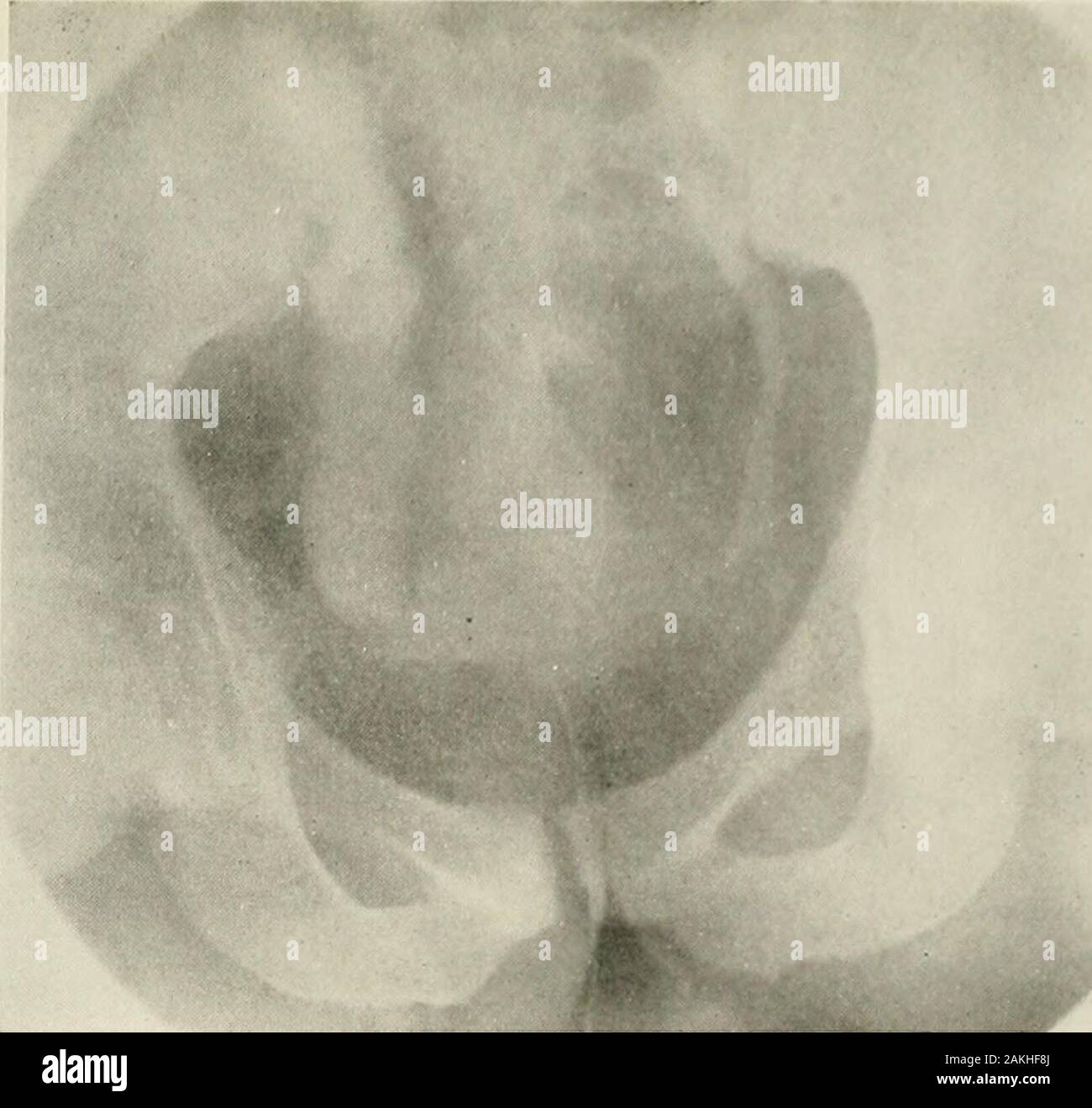 Pyelography (pyelo-ureterography) a study of the normal and pathologic ...