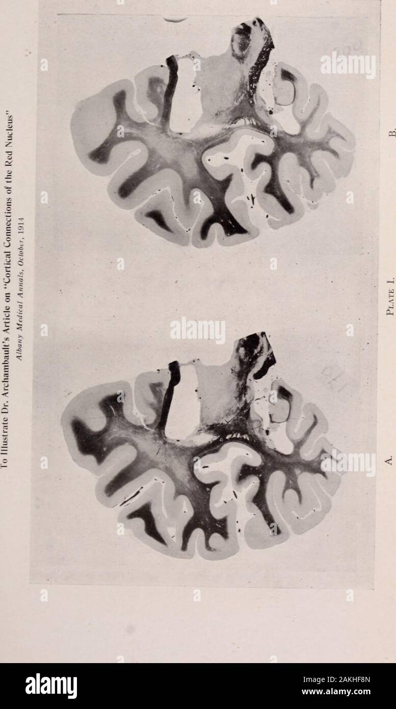 Albany medical annals . mporal cortex, thedegeneration observed in the ...
