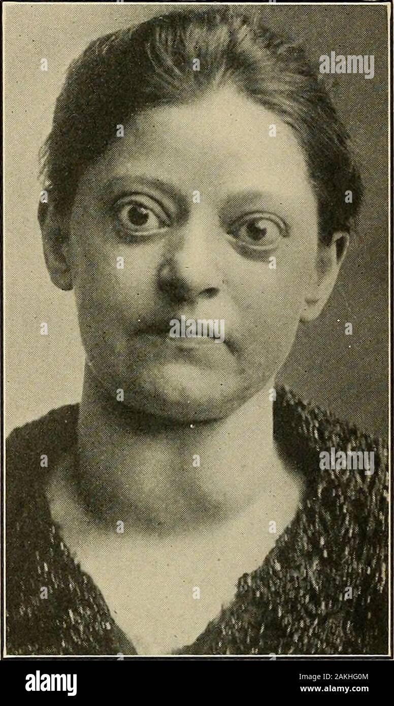 Exophthalmic Goiter Eyes Bulging Information | Mount Sinai New