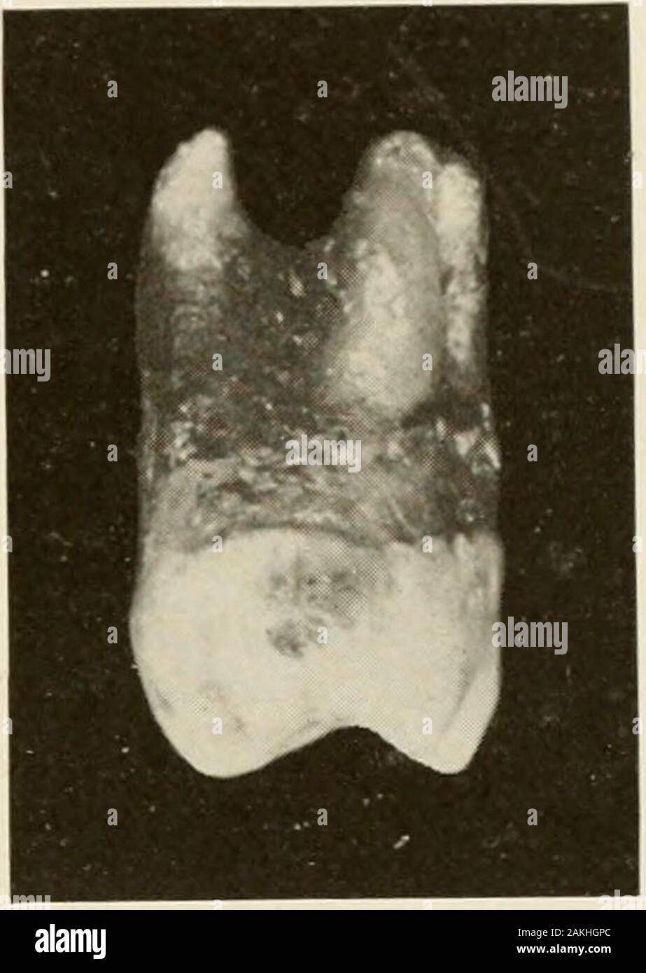 Subgingival hi-res stock photography and images - Alamy