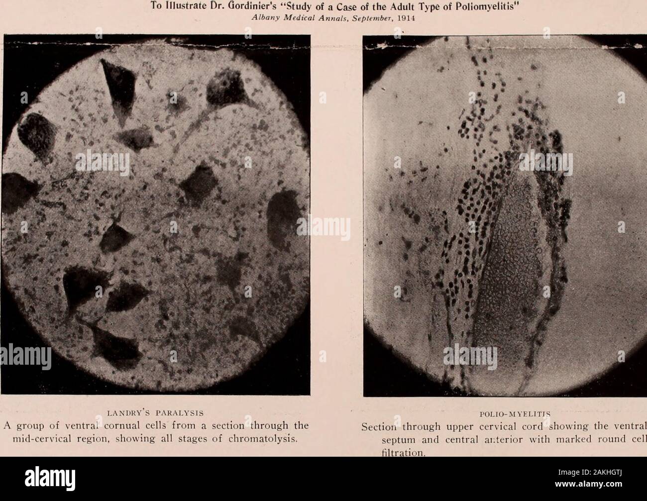 Albany medical annals . Landrys paralysis landrys paralysis Section ...