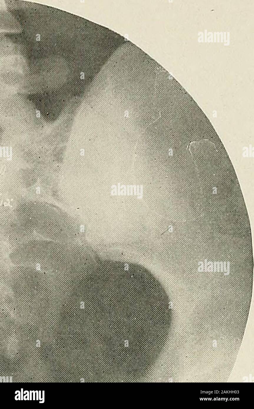 Pyelography (pyelo-ureterography) a study of the normal and pathologic ...
