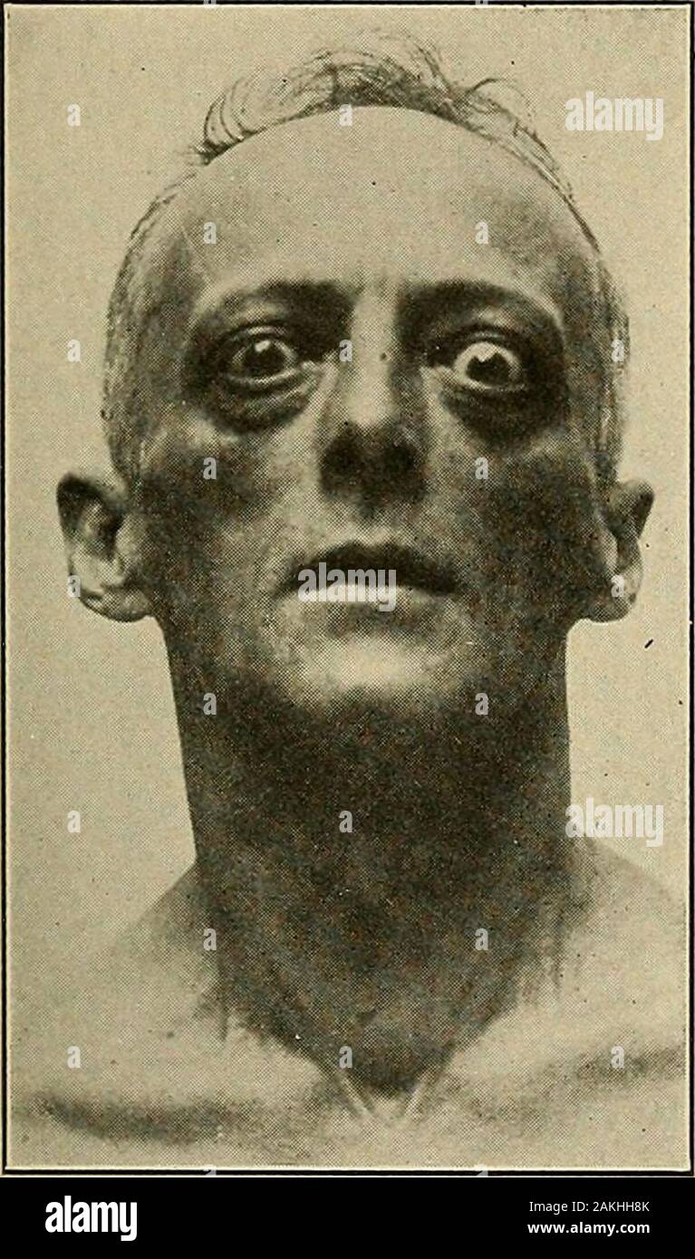 Exophthalmic goitre hi-res stock photography and images - Alamy