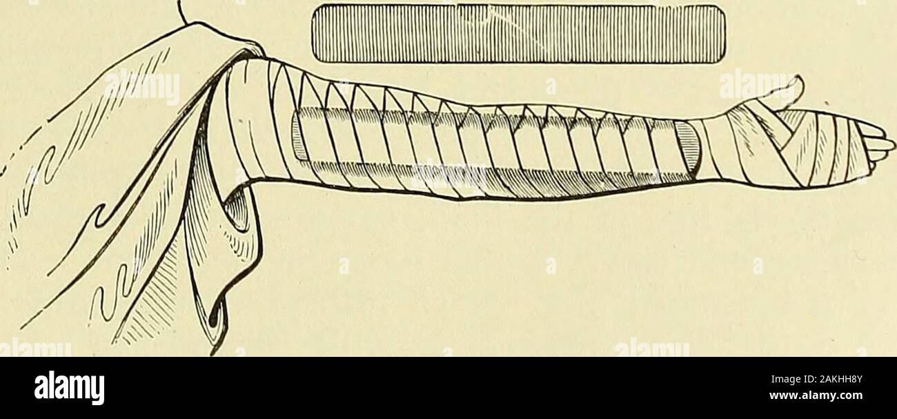 Olecranon process fracture hi-res stock photography and images - Alamy