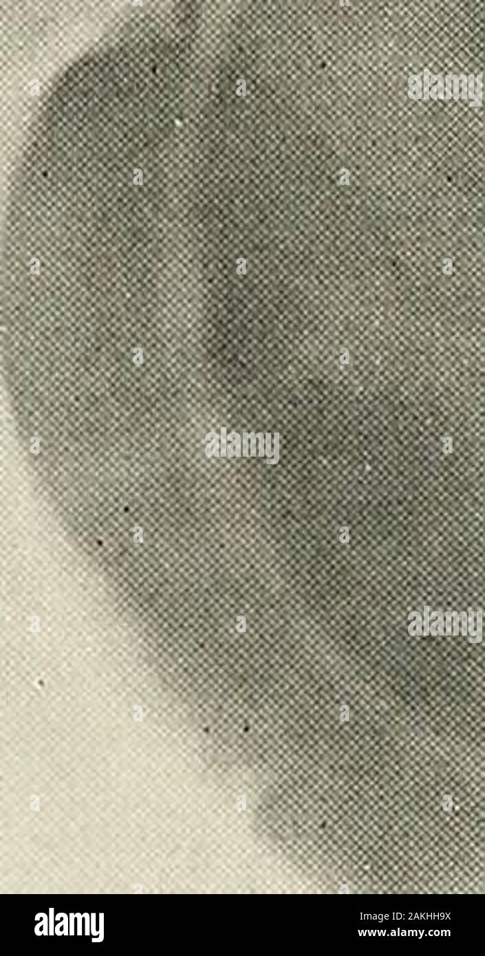 Pyelography (pyelo-ureterography) a study of the normal and pathologic ...