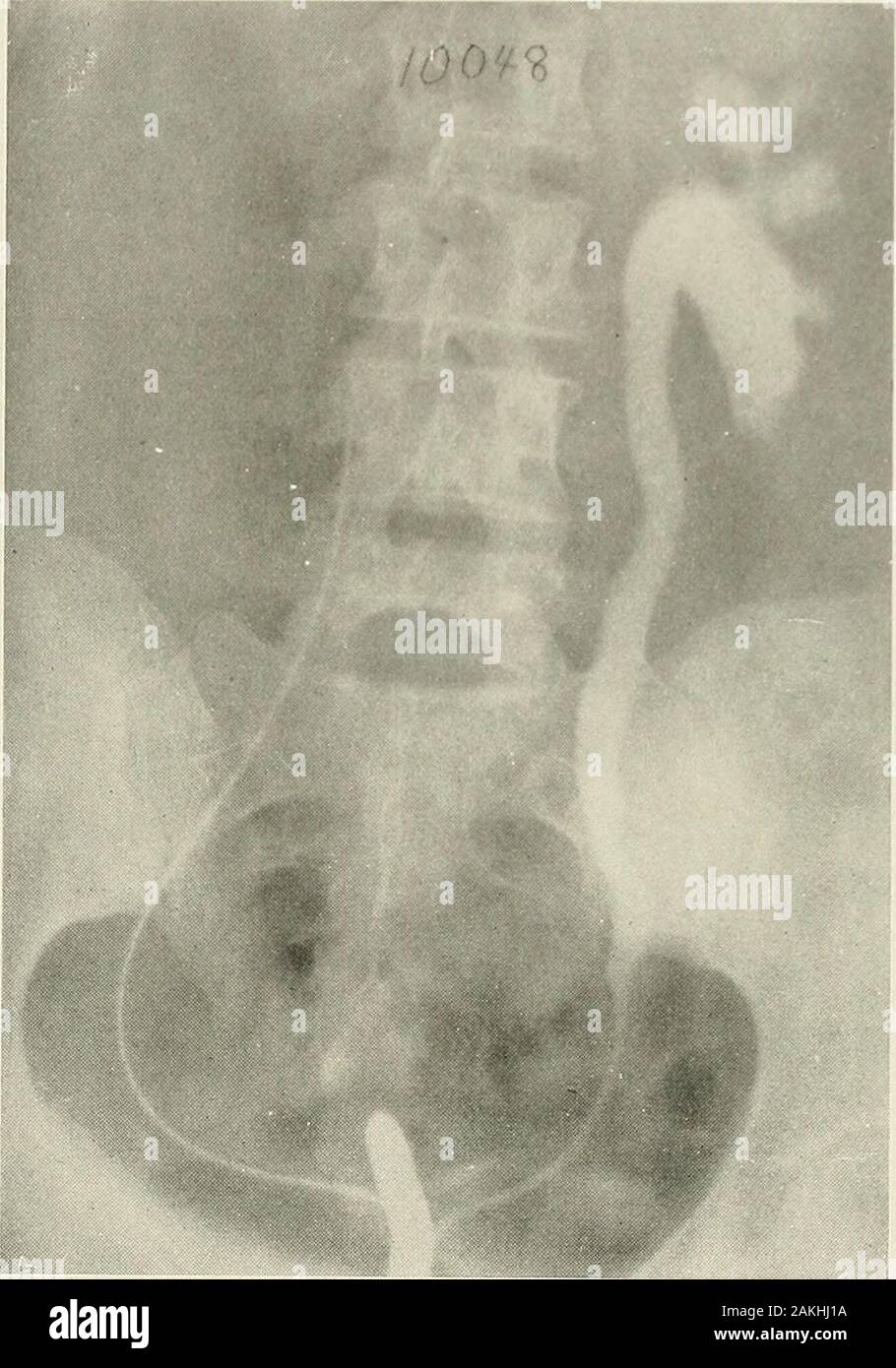 Pyelography (pyelo-ureterography) a study of the normal and pathologic ...