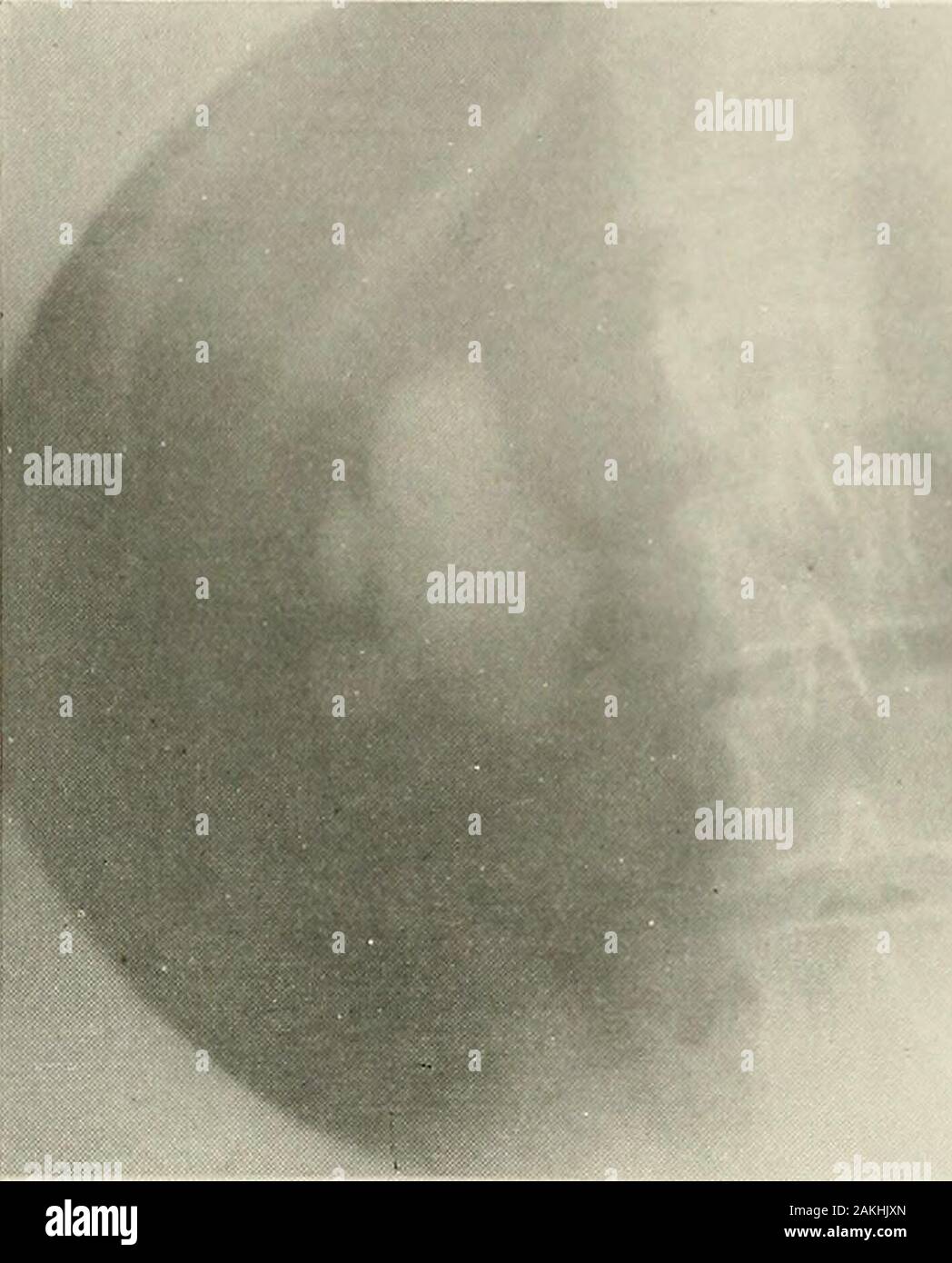 Pyelography (pyelo-ureterography) a study of the normal and pathologic ...