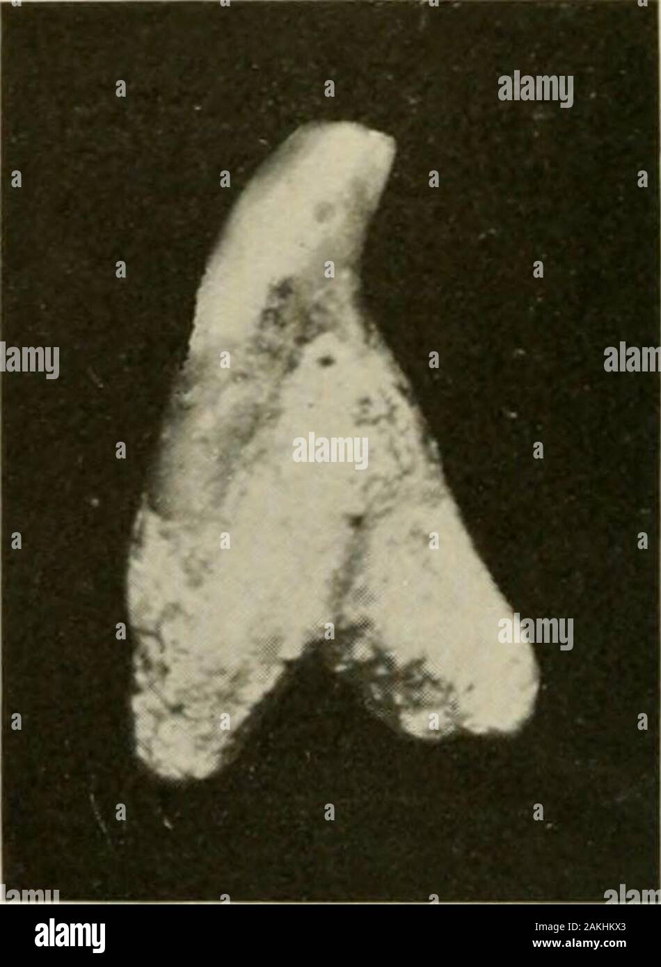 Salivary calculi hi-res stock photography and images - Alamy