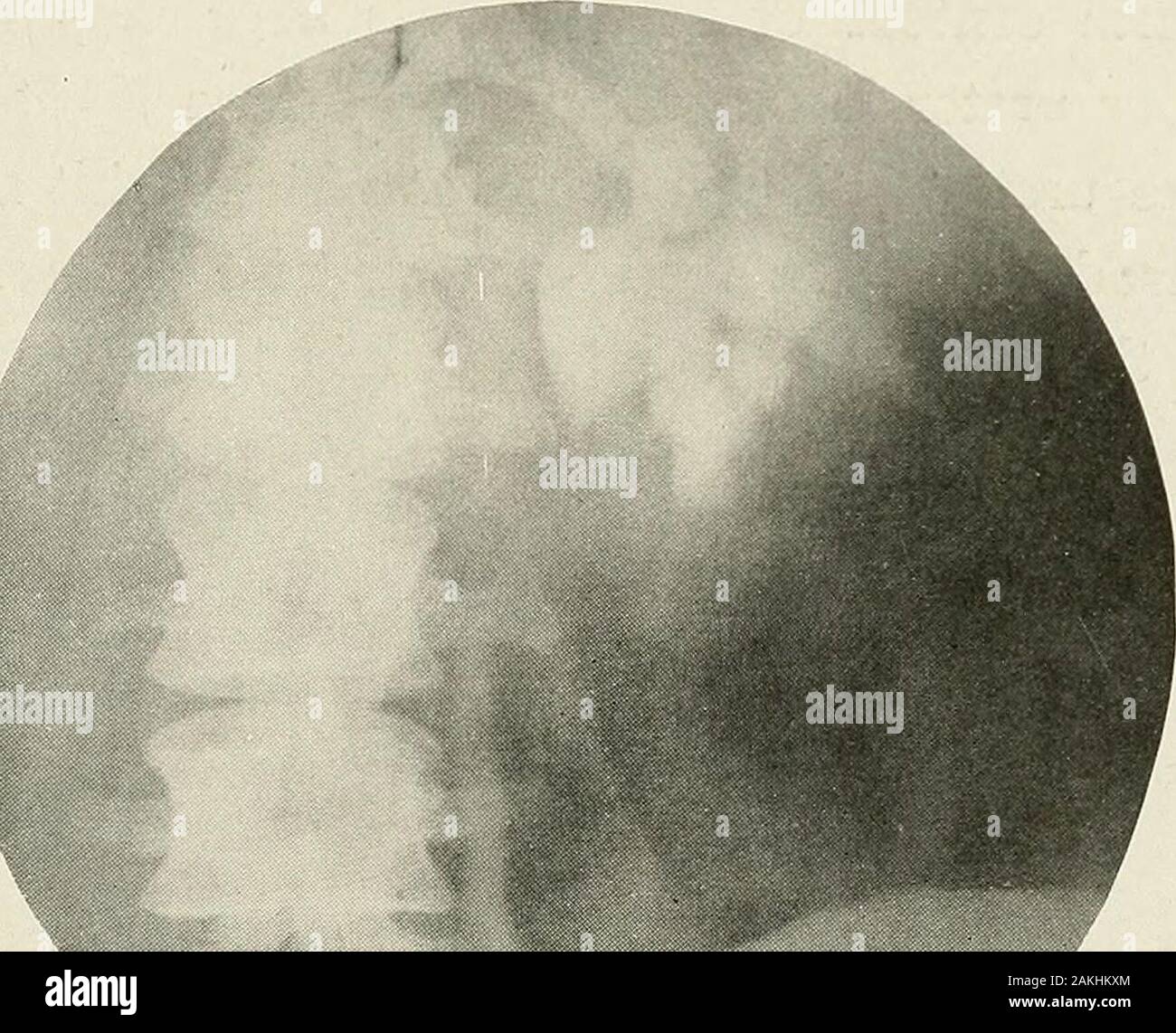 Pyelography (pyelo-ureterography) a study of the normal and pathologic ...