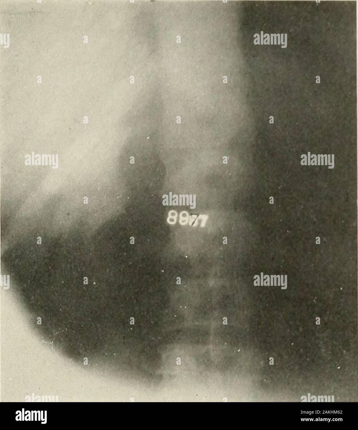 Pyelography (pyelo-ureterography) a study of the normal and pathologic ...