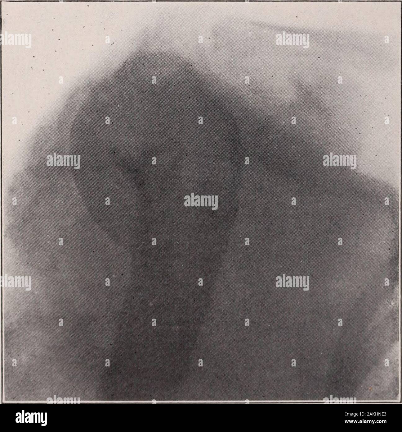 March fractures hi-res stock photography and images - Alamy