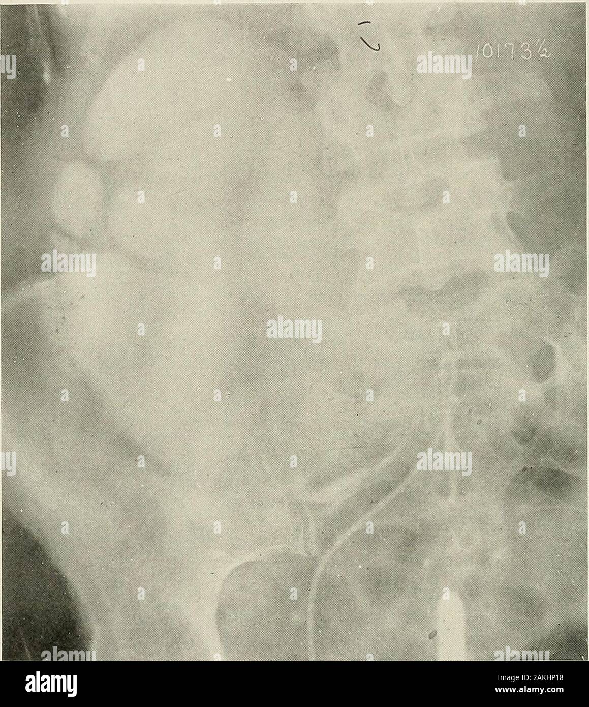 Pyelography (pyelo-ureterography) a study of the normal and pathologic ...