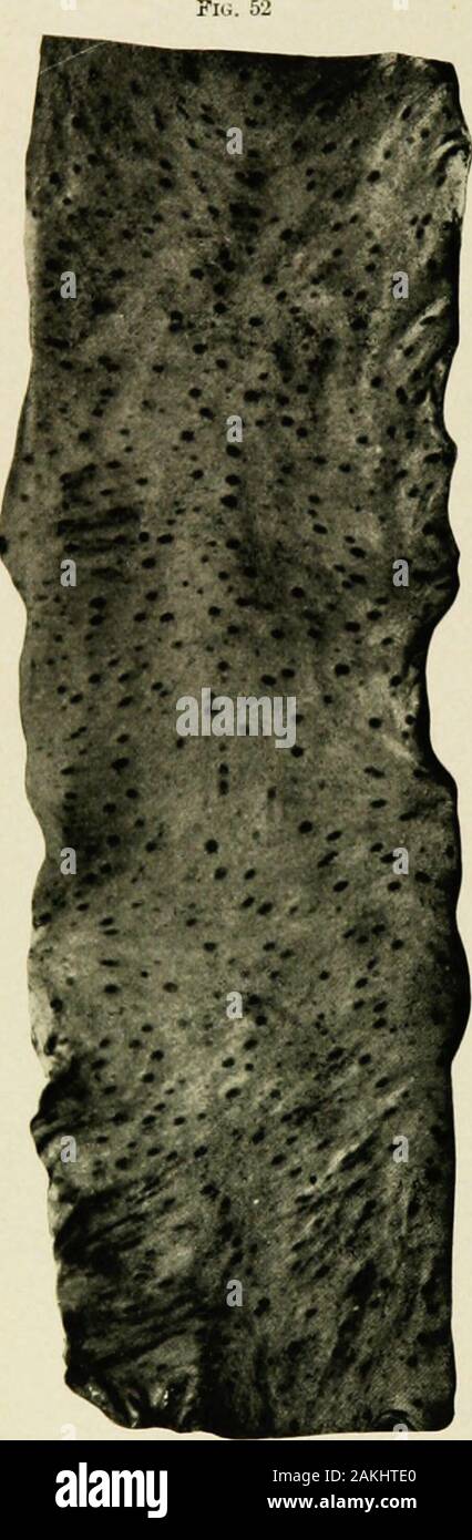 Enlarged colon hi-res stock photography and images - Alamy