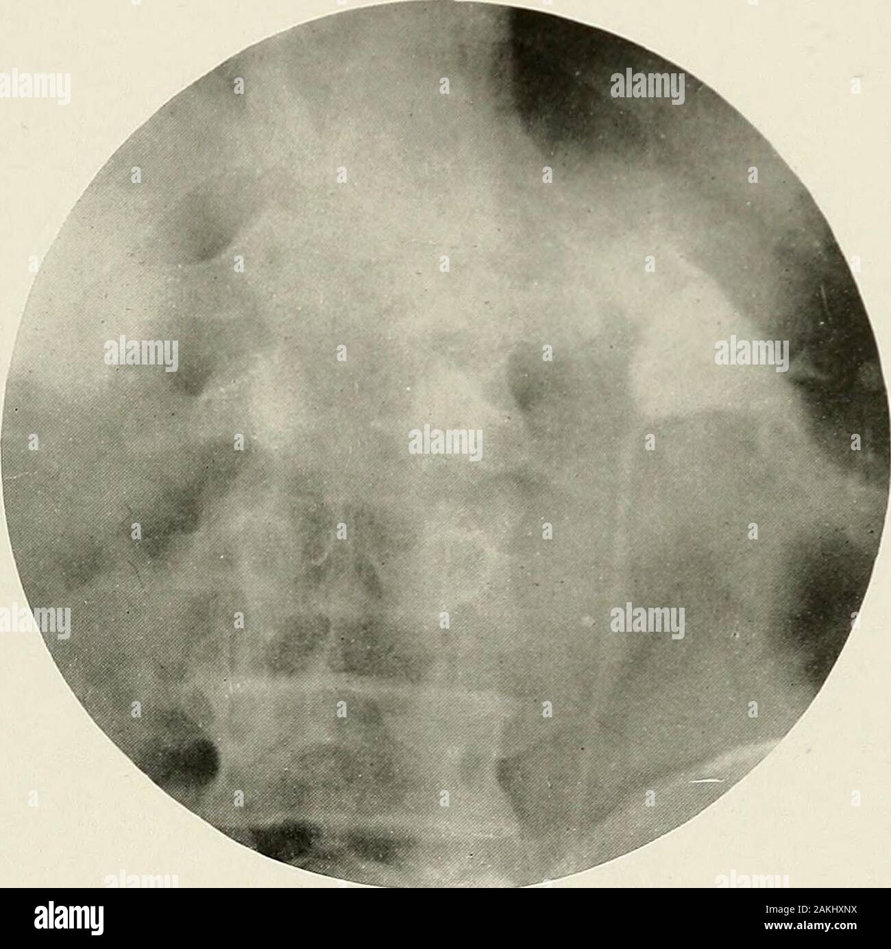 Pyelography (pyelo-ureterography) a study of the normal and pathologic ...