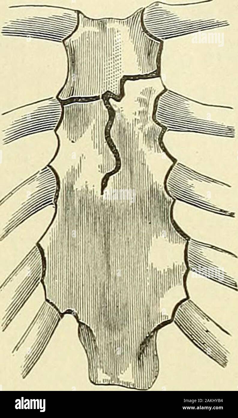 Sternum fracture hi-res stock photography and images - Alamy