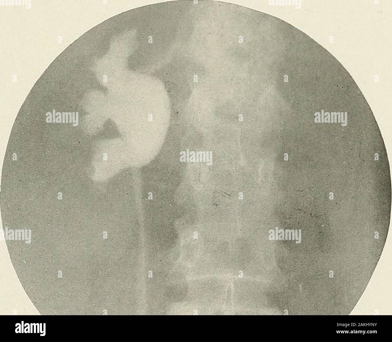 Renal calyces hi-res stock photography and images - Alamy