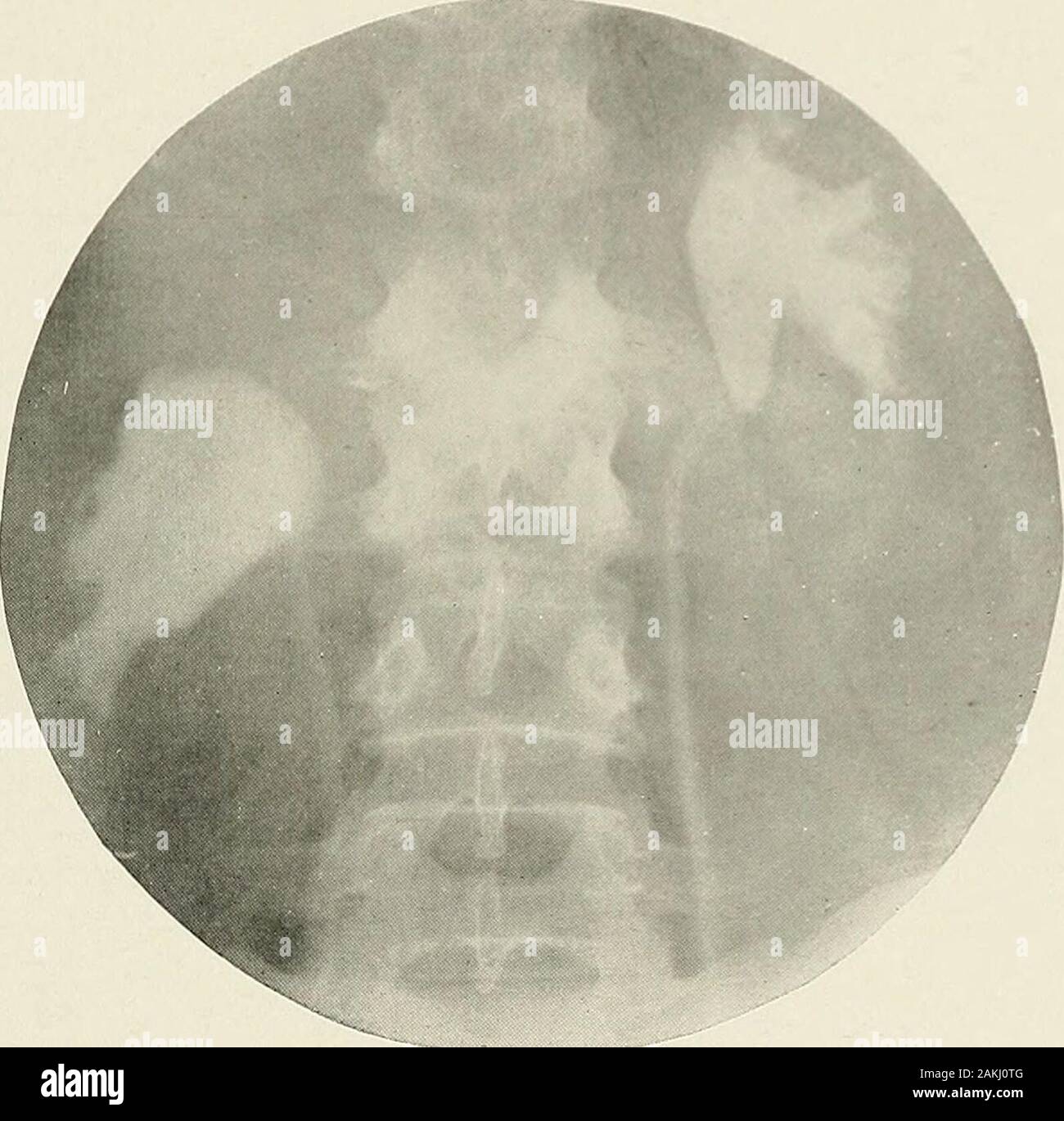 Pyelography (pyelo-ureterography) a study of the normal and pathologic ...