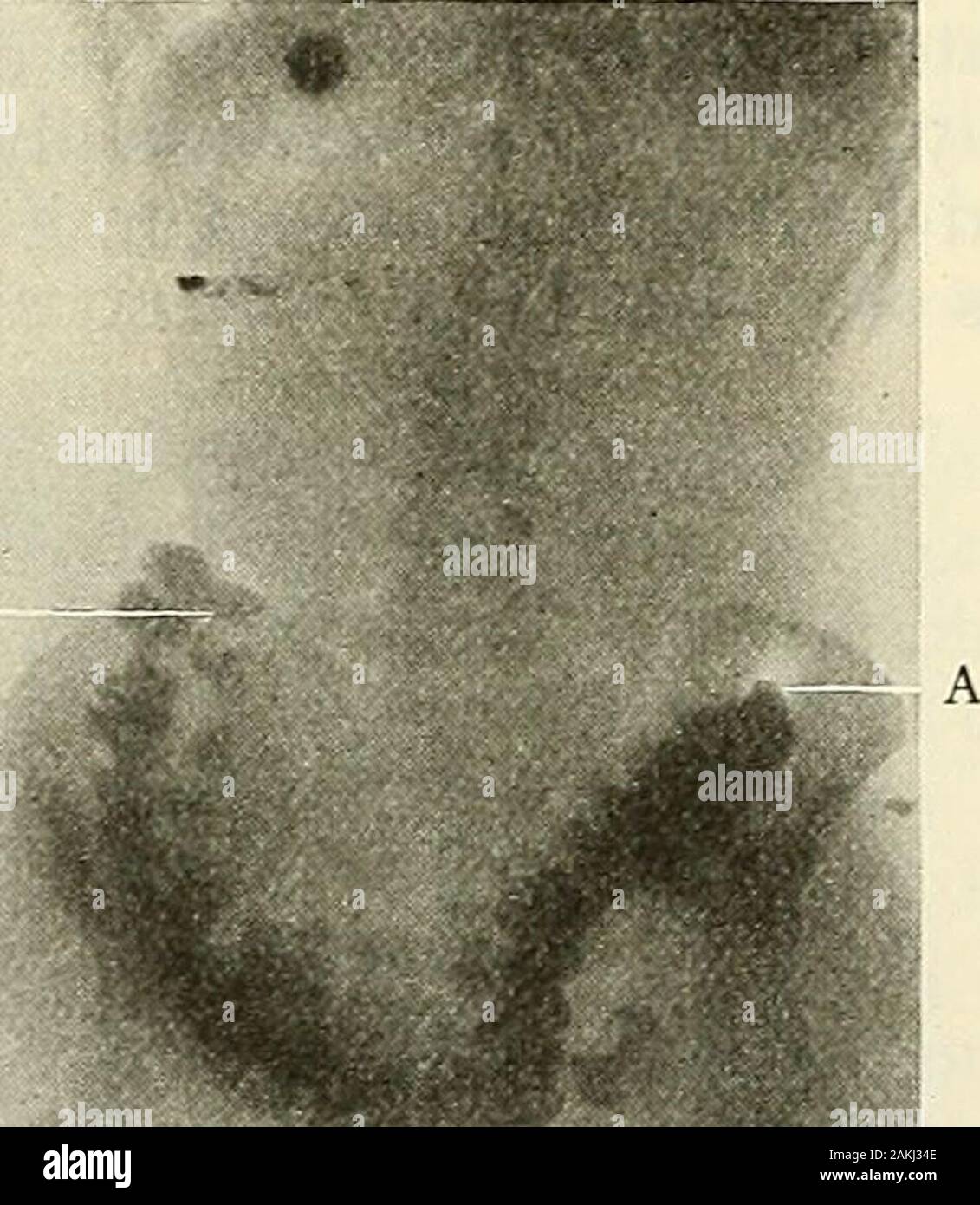 Impacted colon hi-res stock photography and images - Alamy