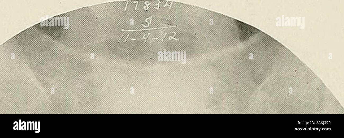 Pyelography (pyelo-ureterography) a study of the normal and pathologic ...