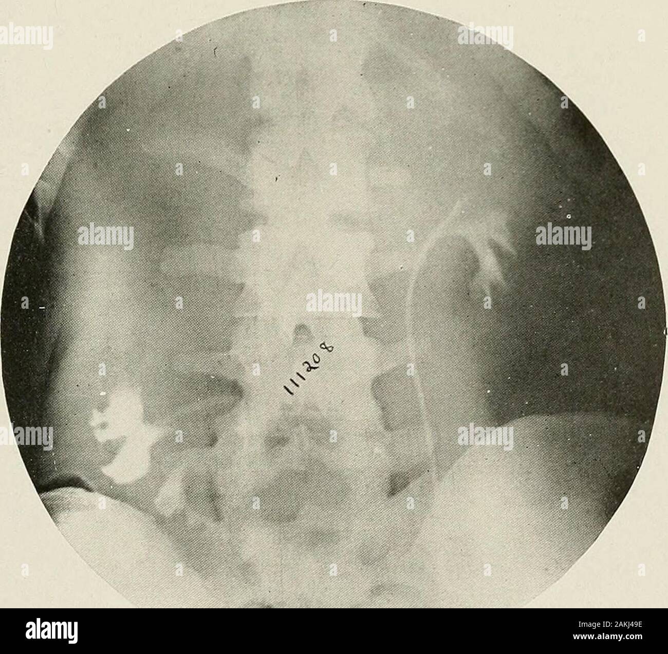 Pyelography (pyelo-ureterography) a study of the normal and pathologic ...