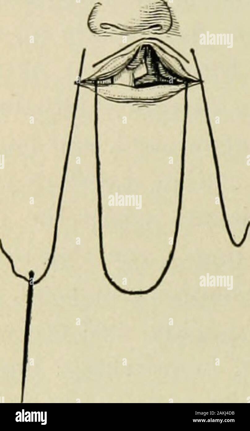 Surgical incision bleeding hi-res stock photography and images - Alamy