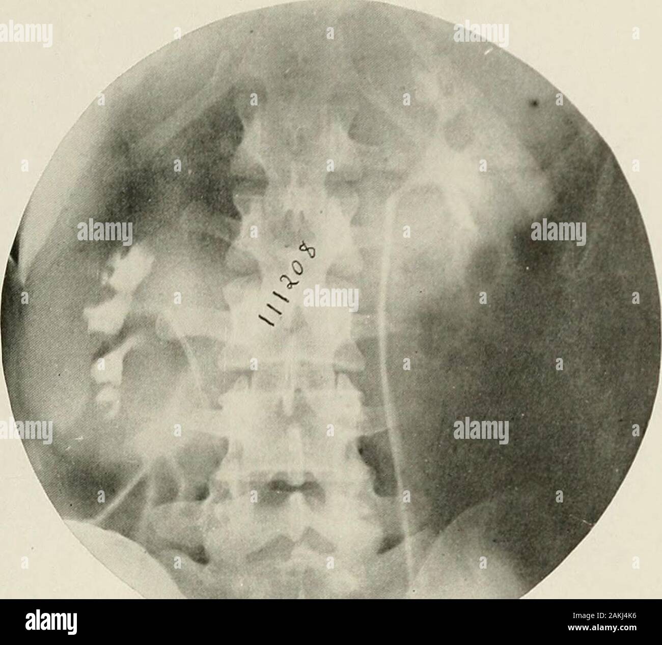 Pyelography (pyelo-ureterography) a study of the normal and pathologic ...
