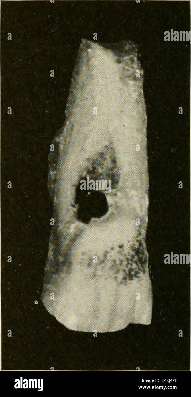 La caries dental hi-res stock photography and images - Alamy